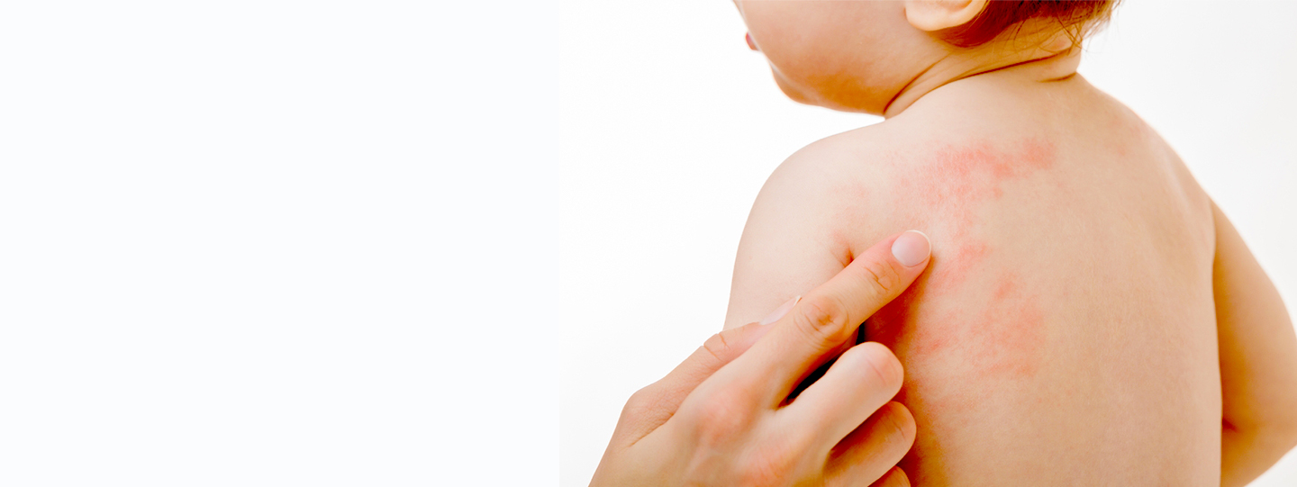 Pediatric Allergies: Common Triggers and How to Keep Your Child Safe ...